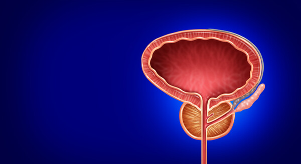 Hemorrhagic cystitis could occur in prostate cancer patients 1 year ...