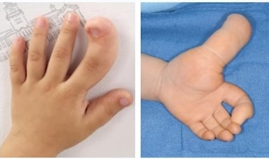 Why hasn’t modern medicine been able to treat macrodactyly satisfactorily?