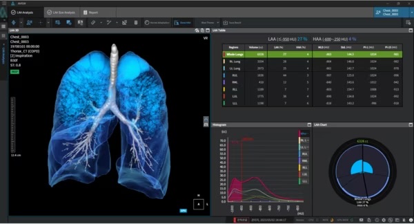 Coreline Soft doubles AI teleradiology contract price in European deal