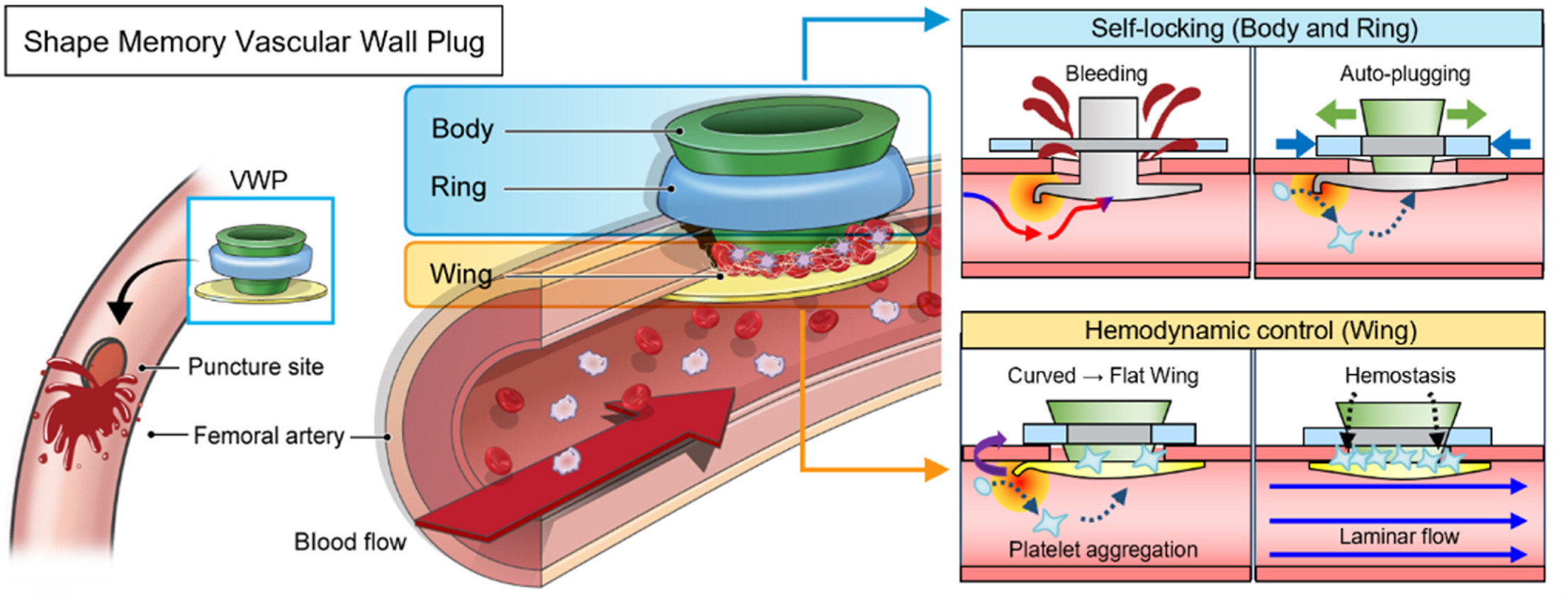 New vascular closure device aims to reduce complications from catheter ...