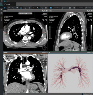 Coreline Soft scores nod for AI-powered pulmonary embolism detection ...